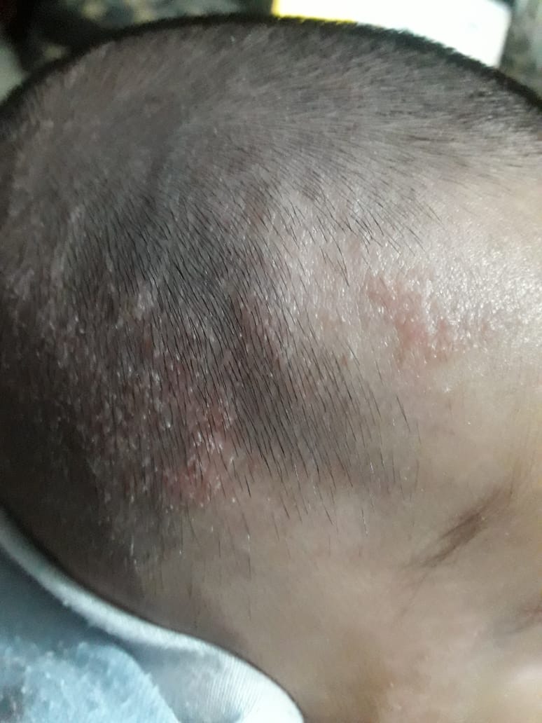 Ask a Dermatologist Online for Severe Dandruff And Scaly Skin