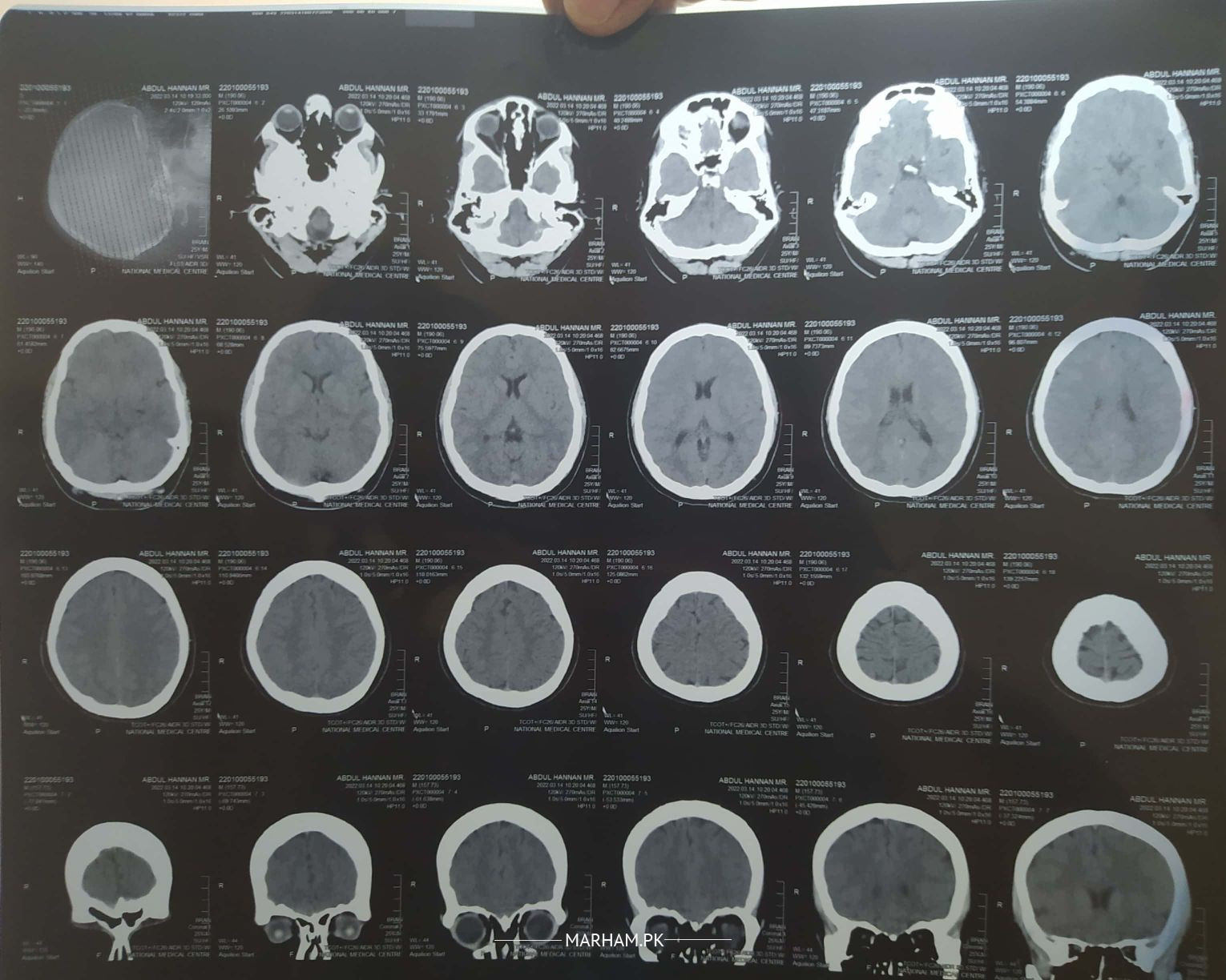 Ask a Neuro - Brain Online for CT Scan Plane Brain