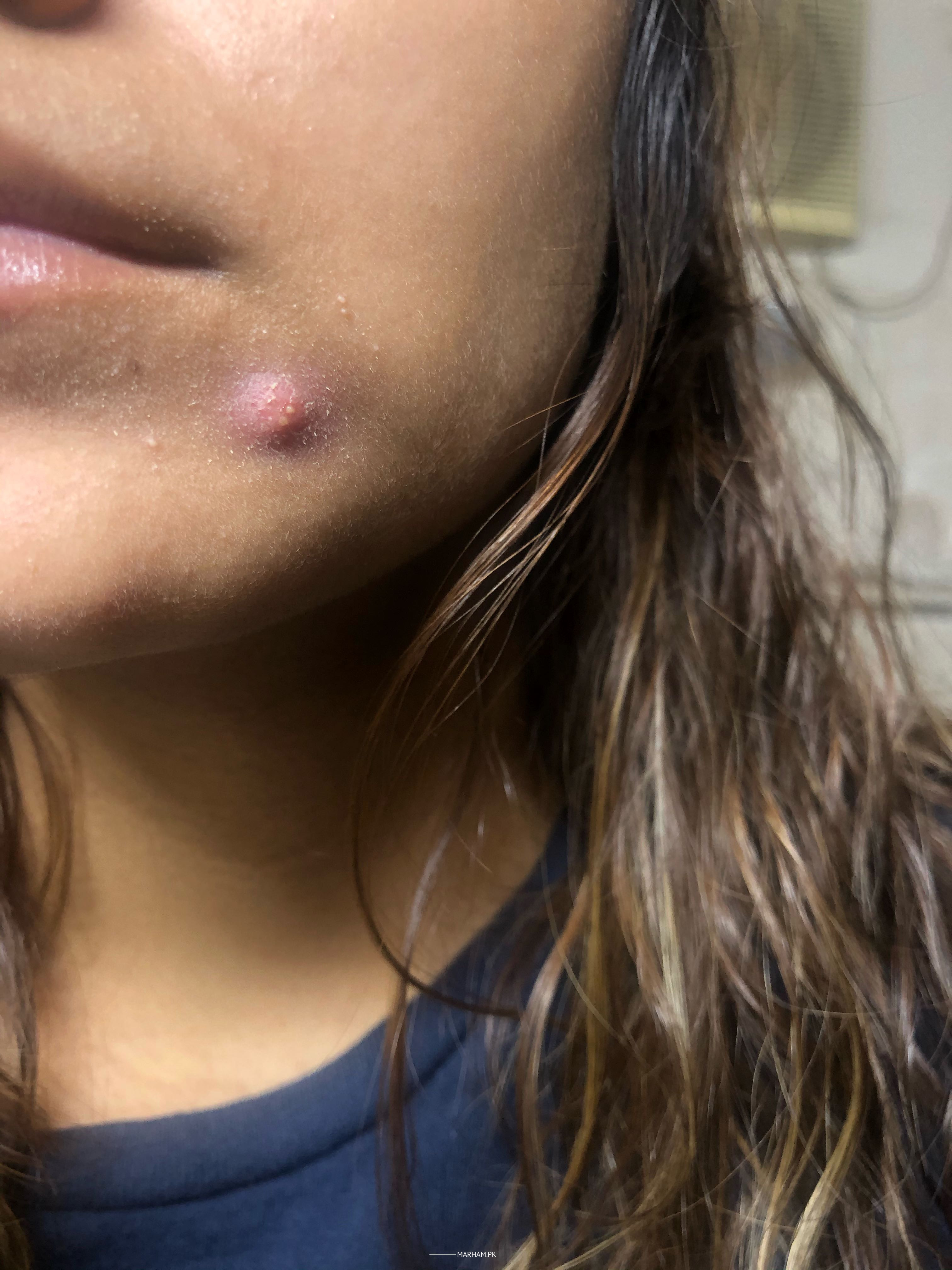 Ask a Dermatologist Online for Painful Pimple