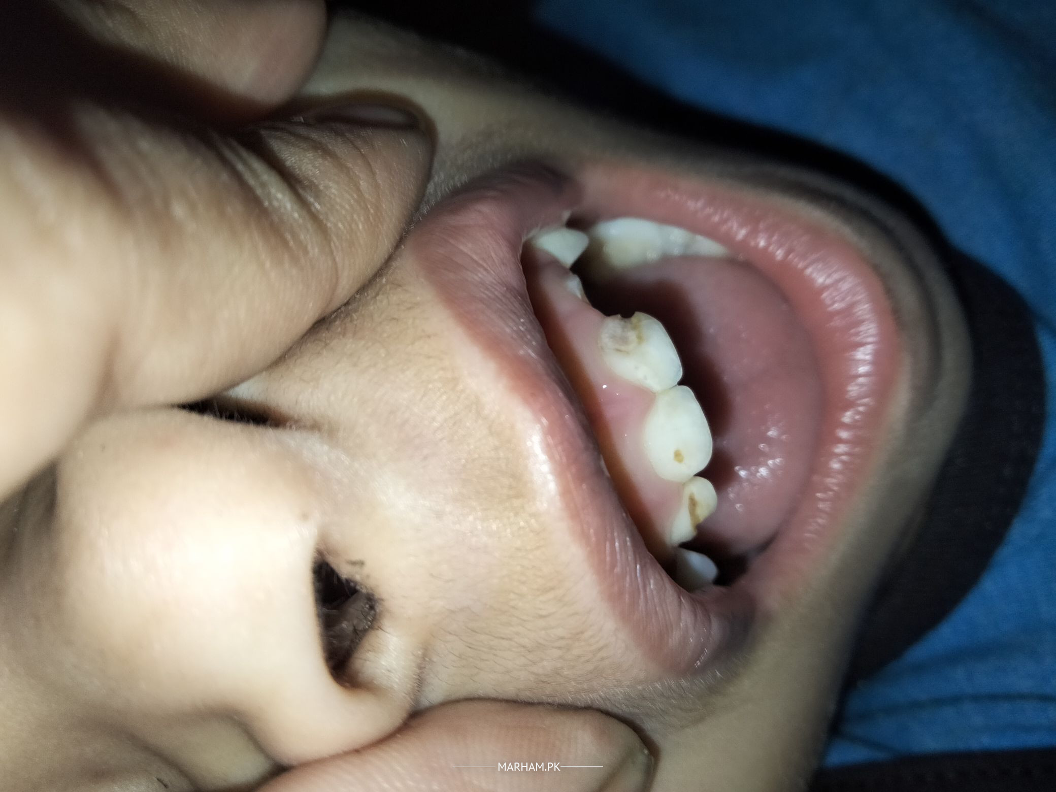 Ask a Dentist Online for Tooth Teeth