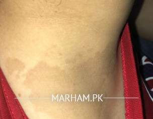 Ask a Dermatologist Online for Marks On Skin (neck Underarms Belly)