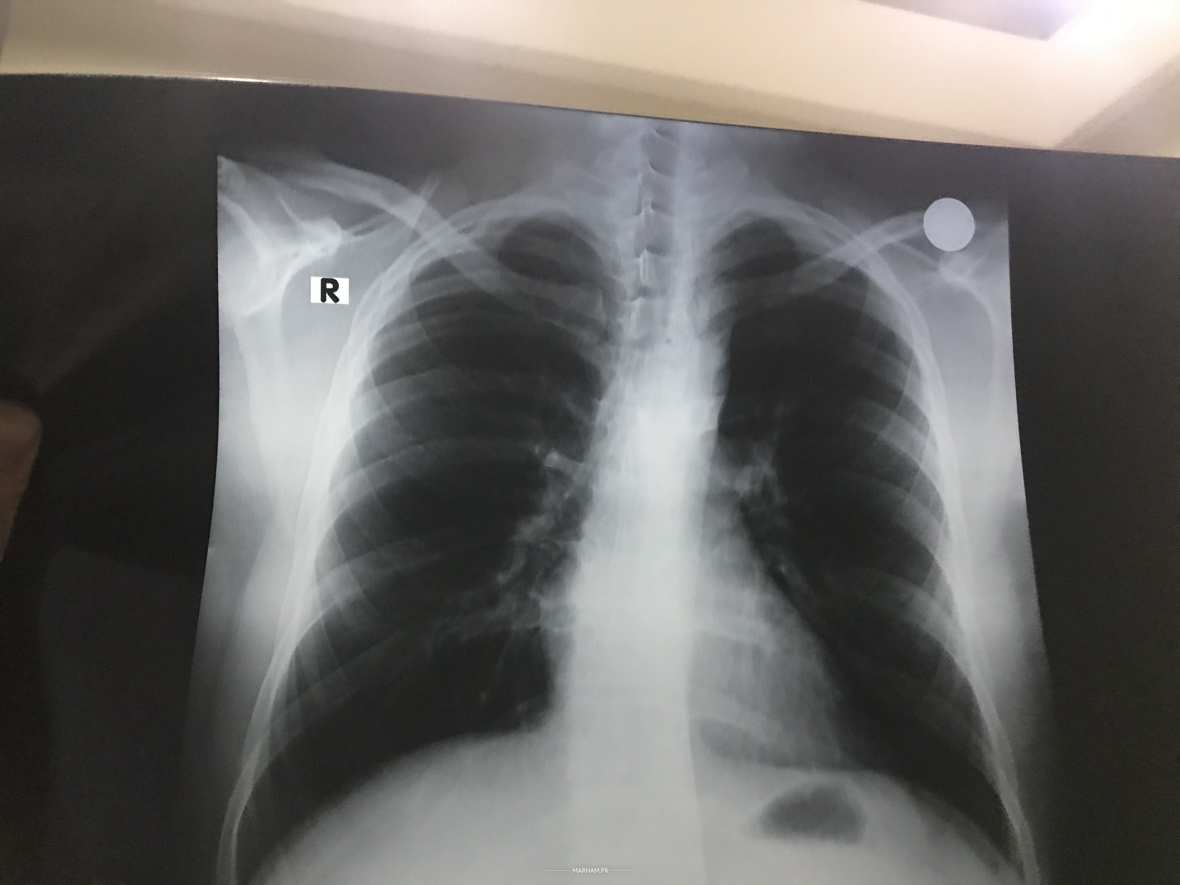 Ask a Chest Respiratory Specialist Online for Please Check Chest X-ray