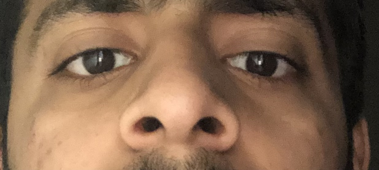 Ask a Dermatologist Online for Fine Line Tear Trough