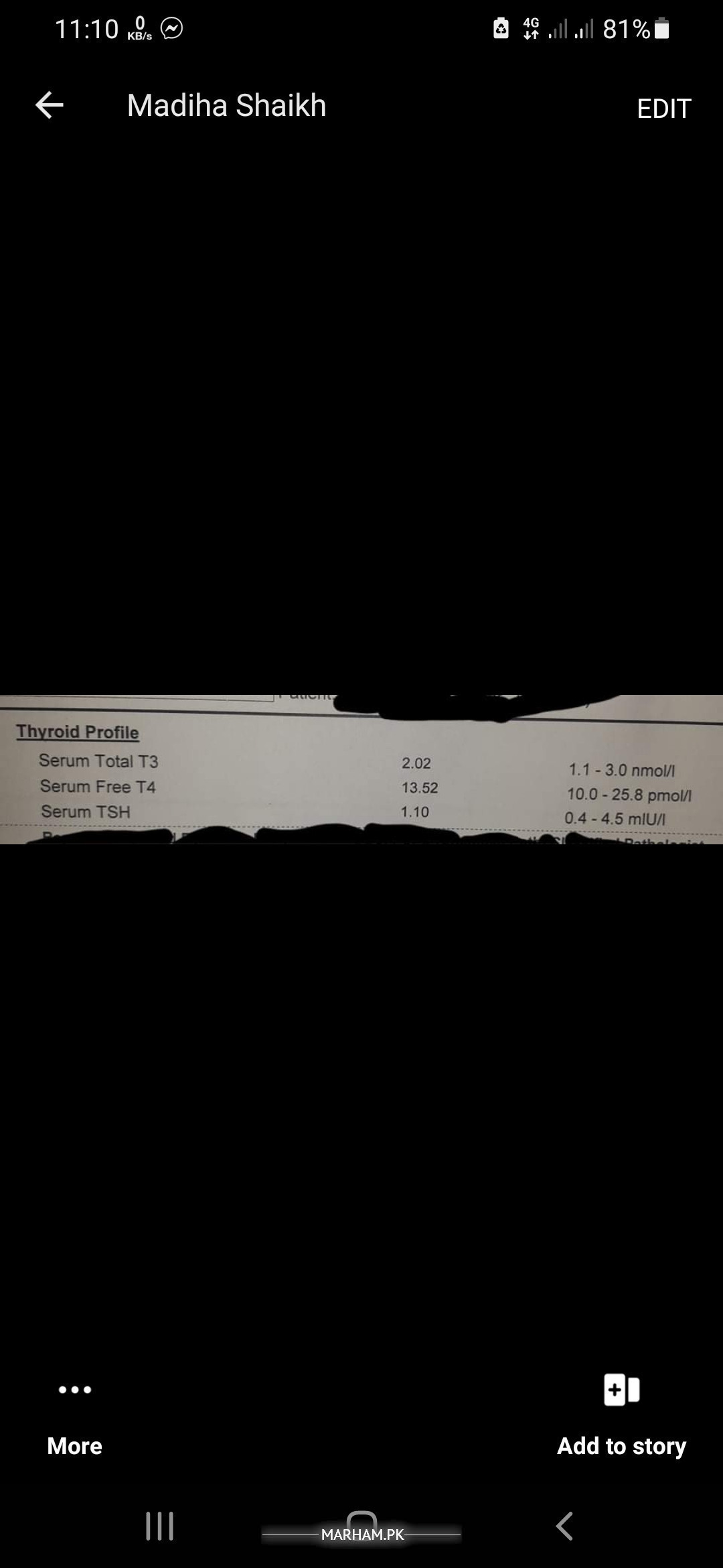 Ask a General Physician Online for Hyperthyroidism