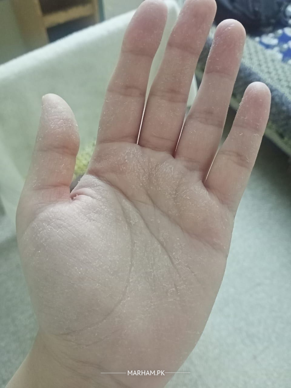 Ask a Dermatologist Online for Skin Peeling From Palms