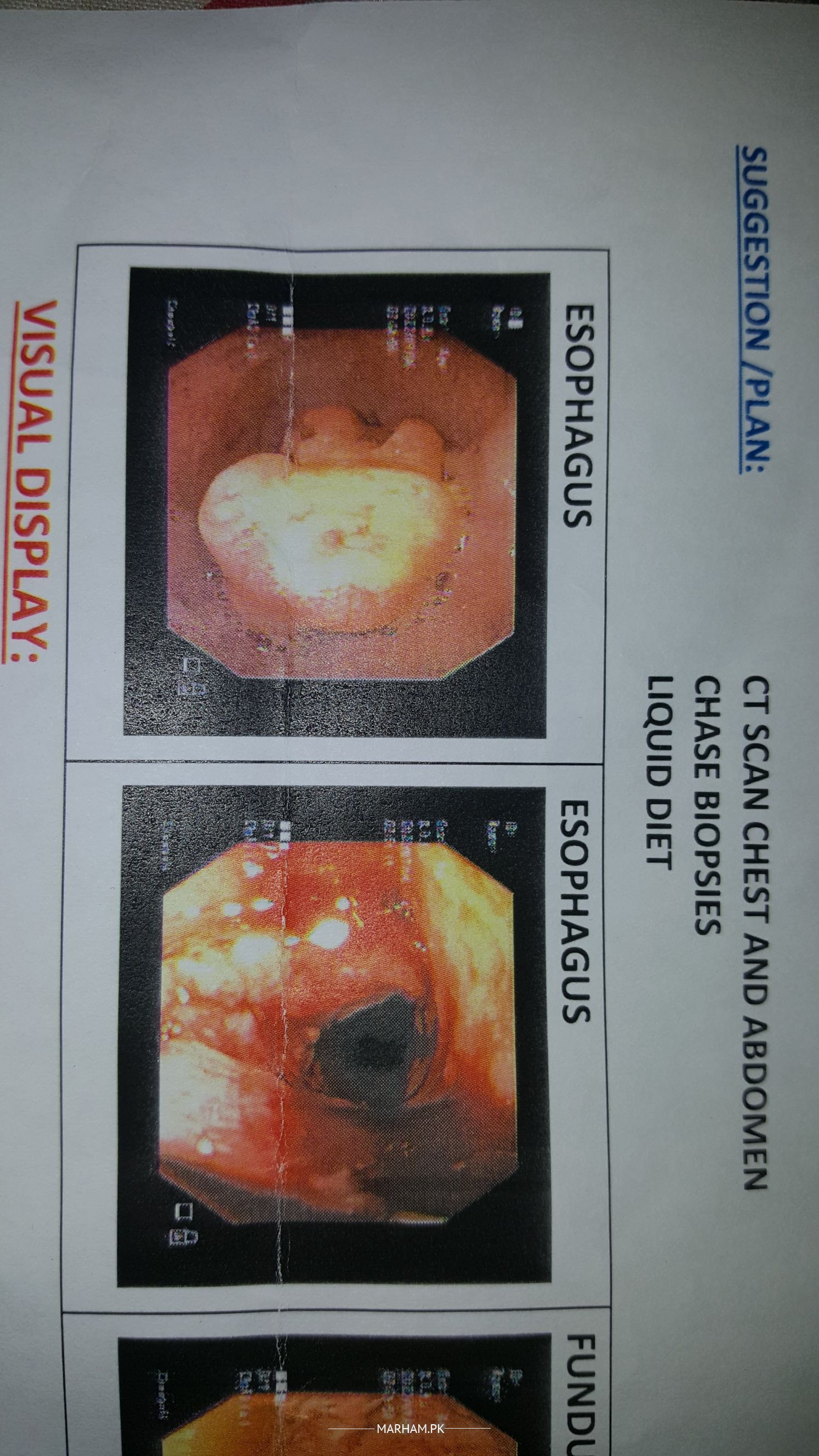Ask a Gastroenterologist Online for Endoscopy Result
