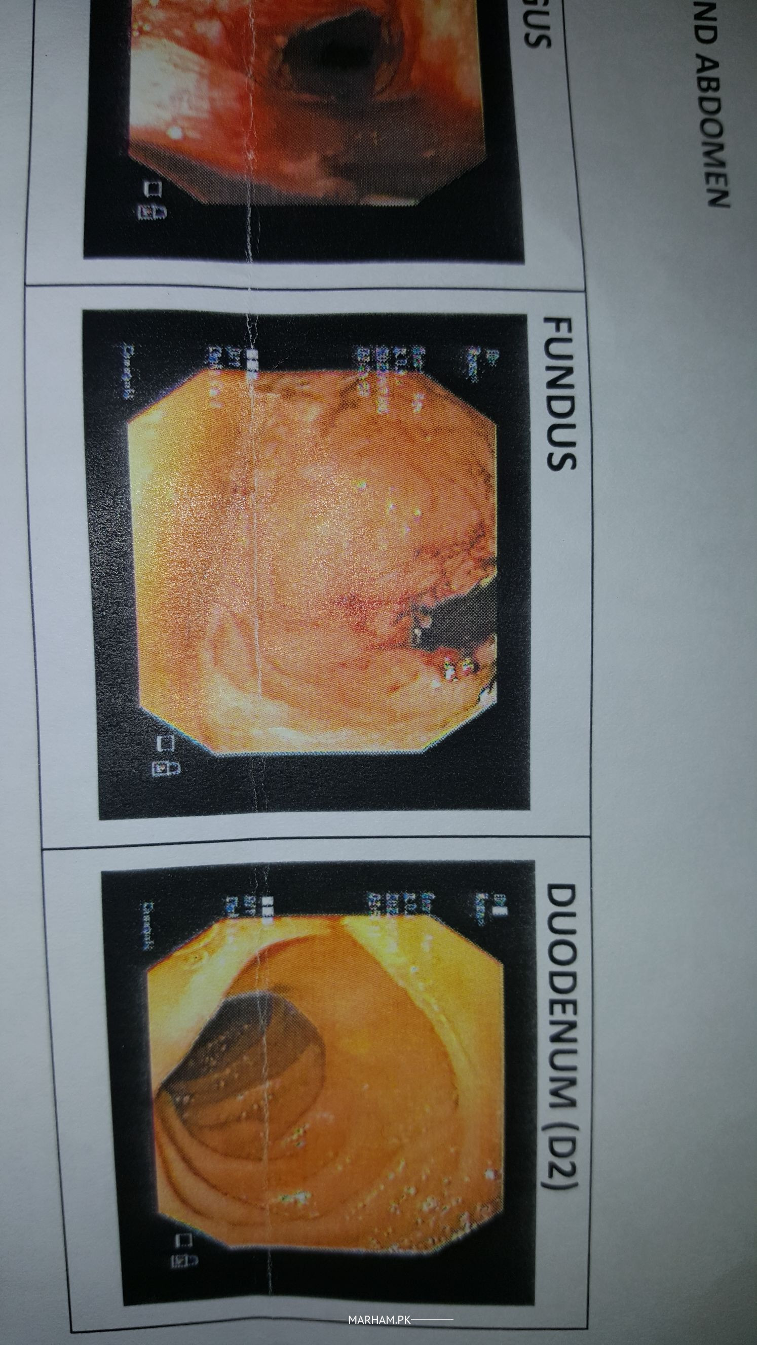 Ask a Gastroenterologist Online for Endoscopy Result