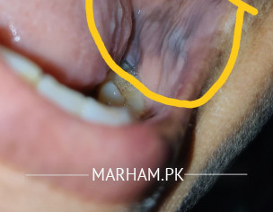 Ask a Dentist Online for Something Black Inside Cheek