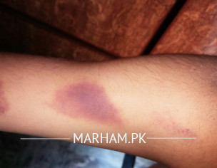 Ask a Dermatologist Online for Red Spots On Arms