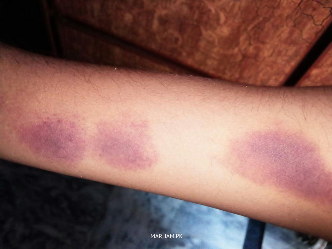 Ask a Dermatologist Online for Red Spot On Arms