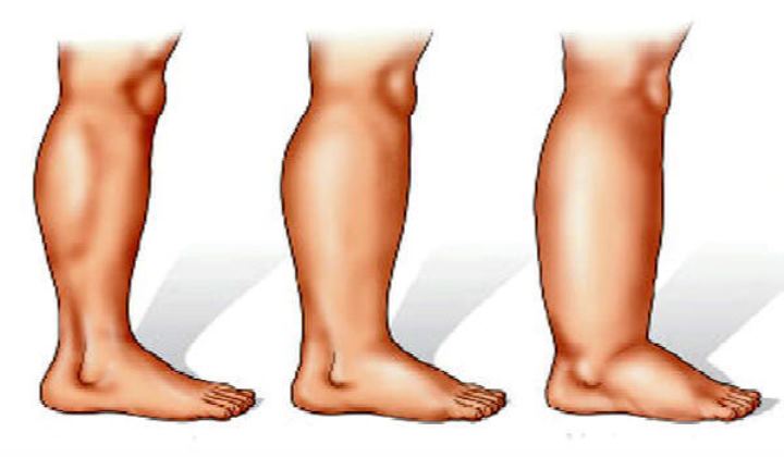 8 Warning Signs of A Blood Clot That You Should Be Aware Of - Small Joys