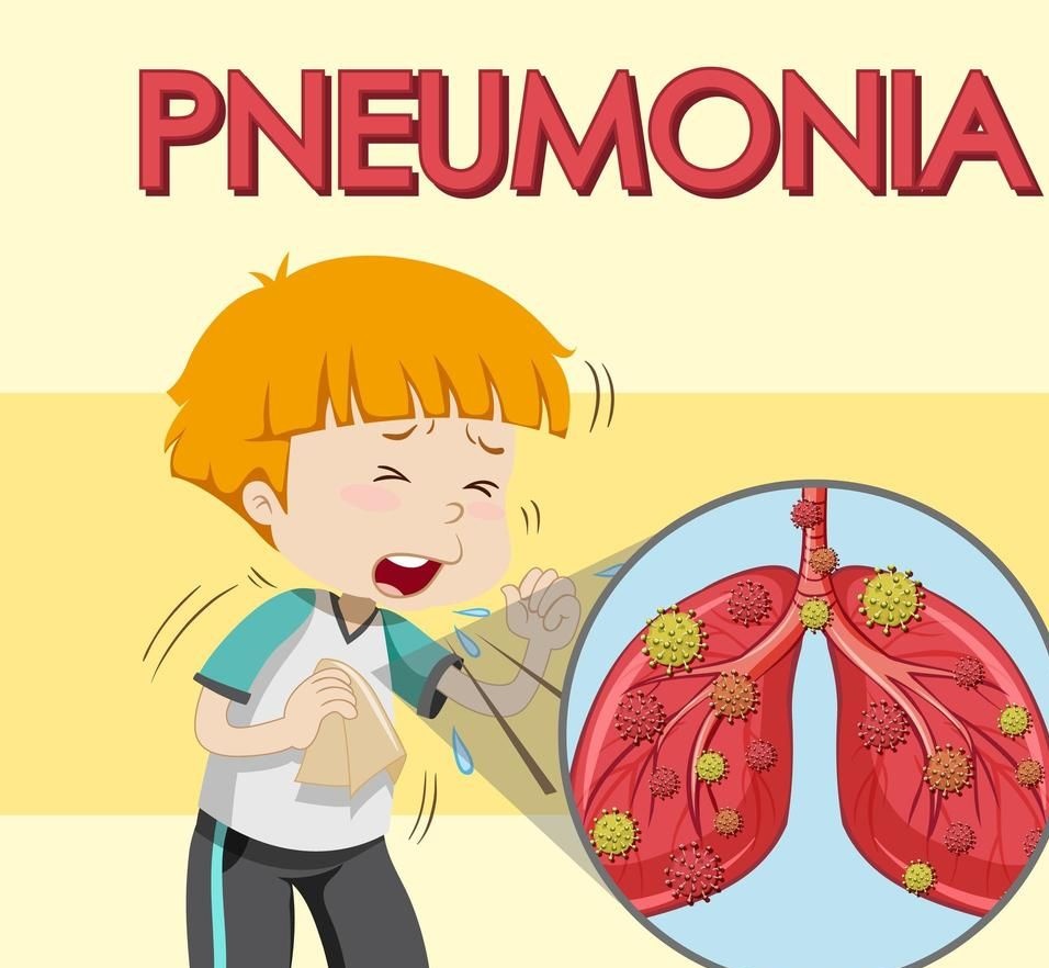 Recurrent Pneumonia: What Is It, and How to Book a Consultation Service ...