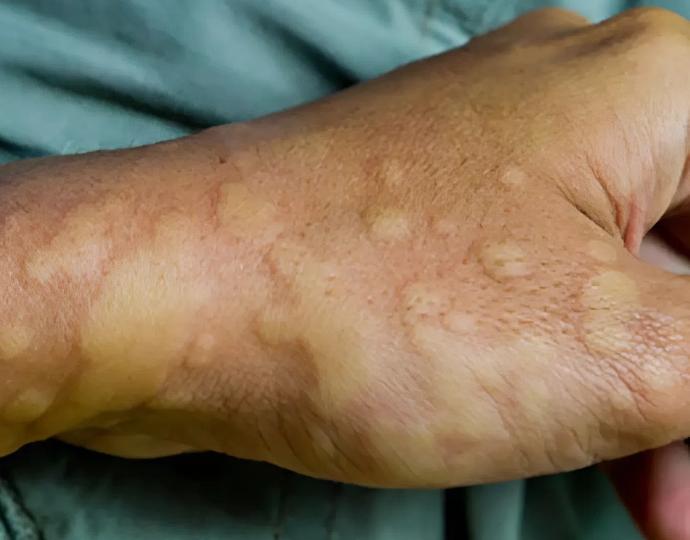 Dermatology Breakdown: Urticaria— More Than Just a Rash