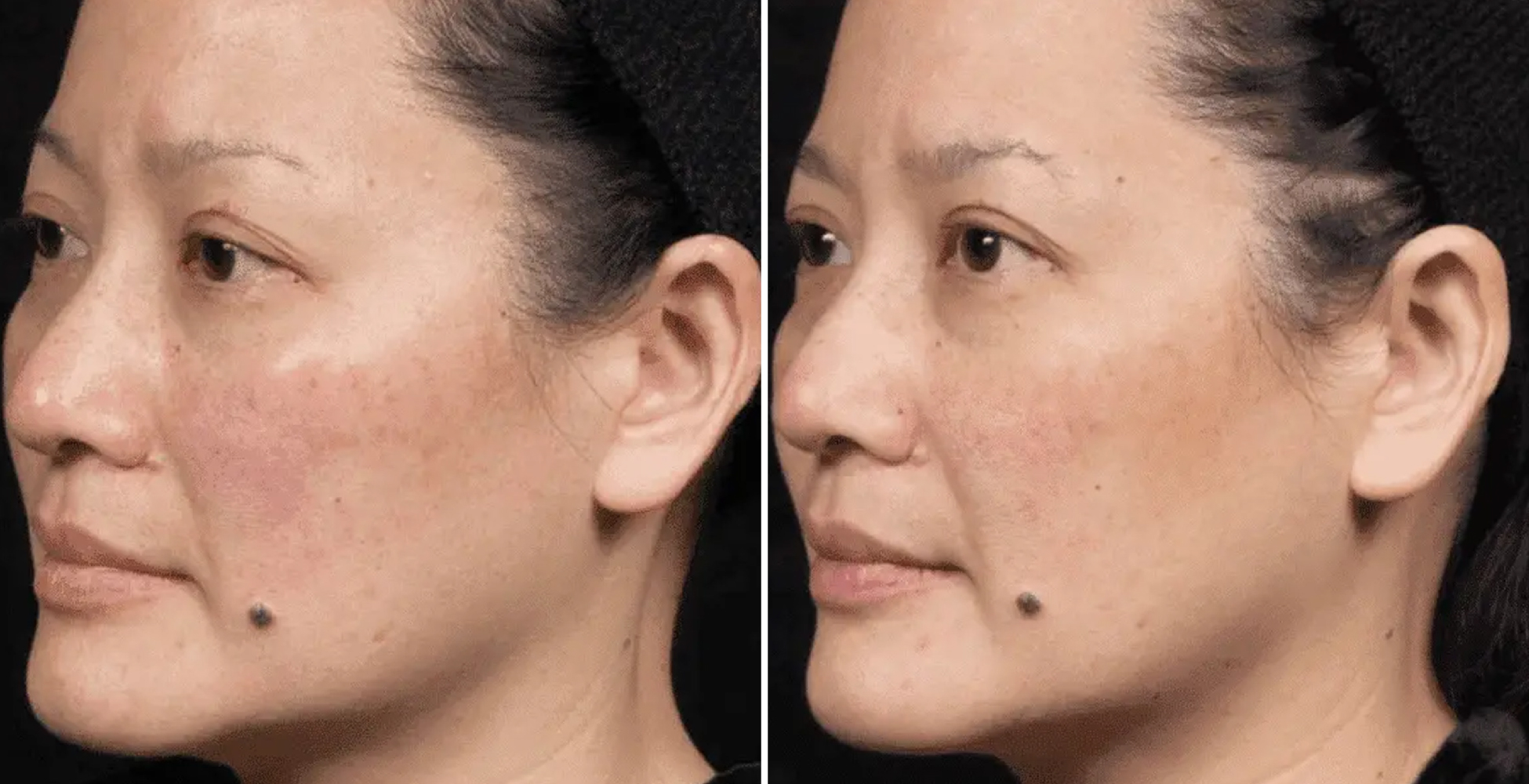 Banish Breakouts: A Guide to A... - Price: US$ 440 - Expert: skinneymedspa
