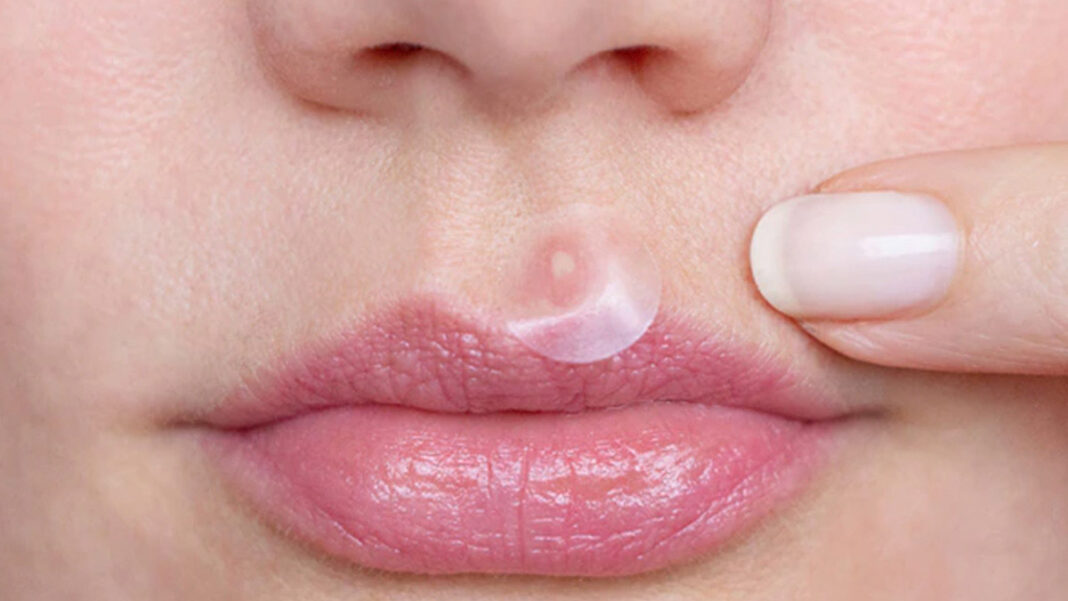 How To Hide Acne & Pimples With & Without Makeup - The Channel 46