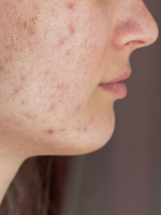 How To Use Colour Corrector To Hide Your Acne? - The Channel 46 ...