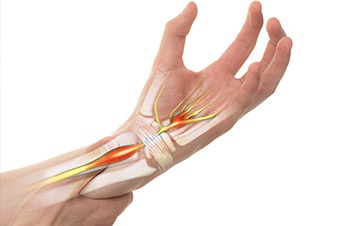 Nerve Damage Specialist - Pittsburgh | Wrist Specialist Near Me