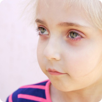 Pediatric Allergic Conjunctivitis Treatment | Eye Doctor Erie