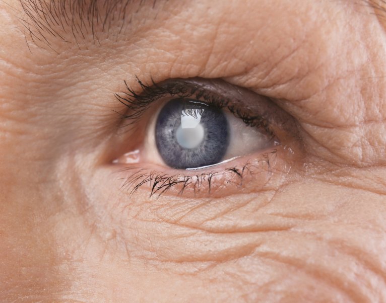 Cataract Surgery Near Me | Ophthalmologist Johnson City TN