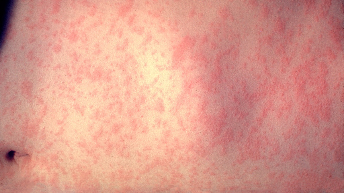 Particle News: First 2025 Measles Cases Confirmed in Cook County