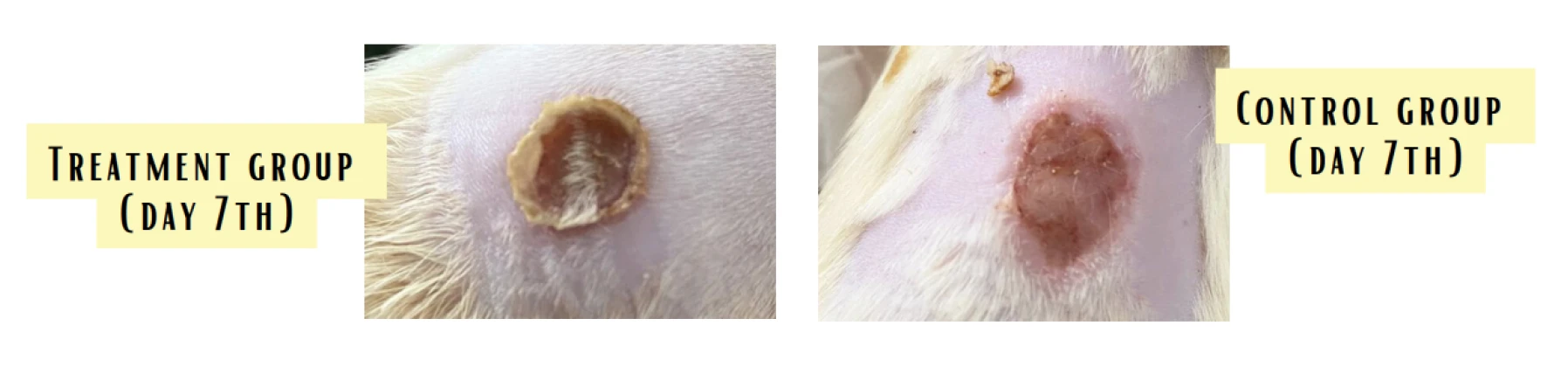 Inovasi Plester Hidrokoloid, Angin Segar Pertolongan Pertama Luka Bakar ...