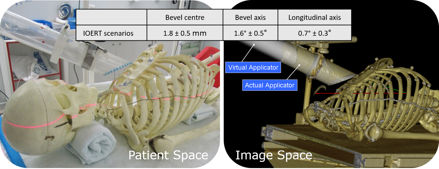 Intraoperative Electron Radiation Therapy – IGT Research Group