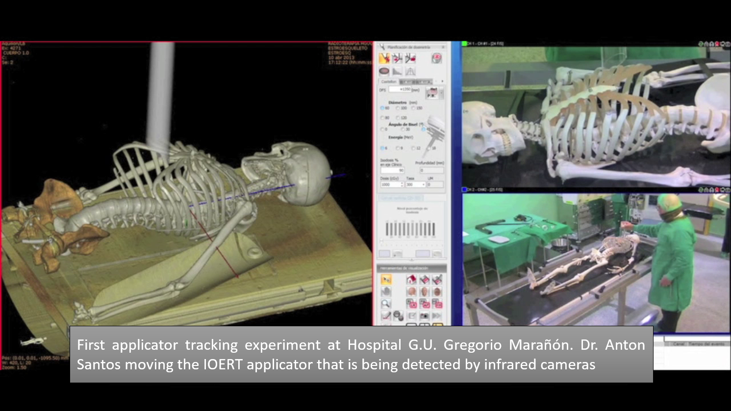 Intraoperative Electron Radiation Therapy – IGT Research Group