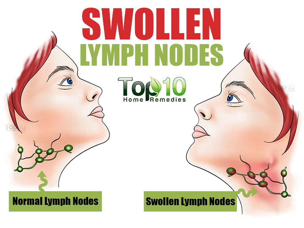 Mouth Ulcers Sore Throat Swollen Lymph Nodes - Infoupdate.org